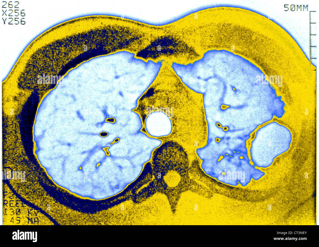 LUNG SCAN FOR EMPHYSEMA Stock Photo - Alamy