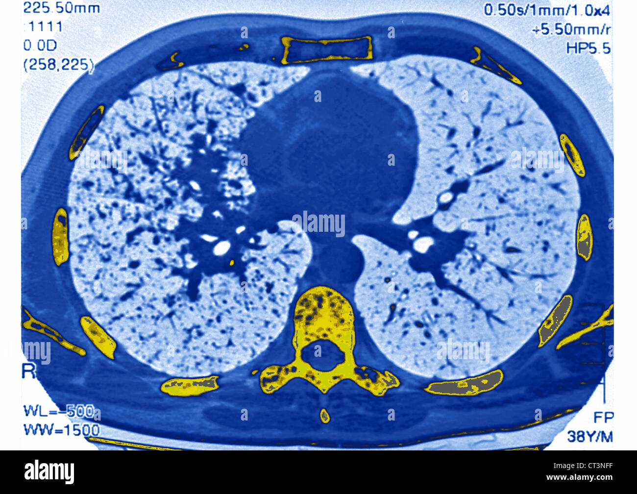 LUNG SARCOIDOSIS, SCAN Stock Photo - Alamy