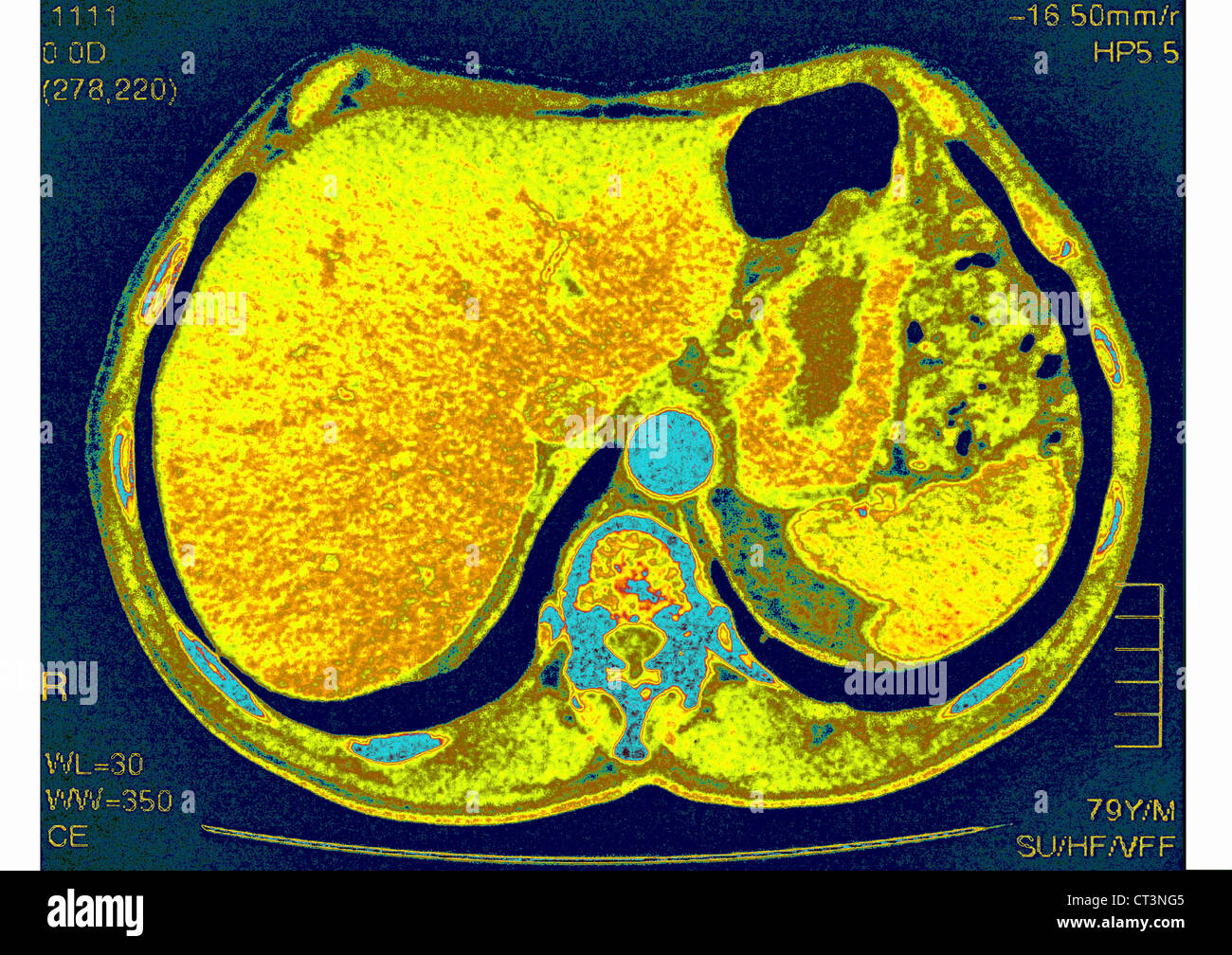 Large intestines scan hi-res stock photography and images - Alamy