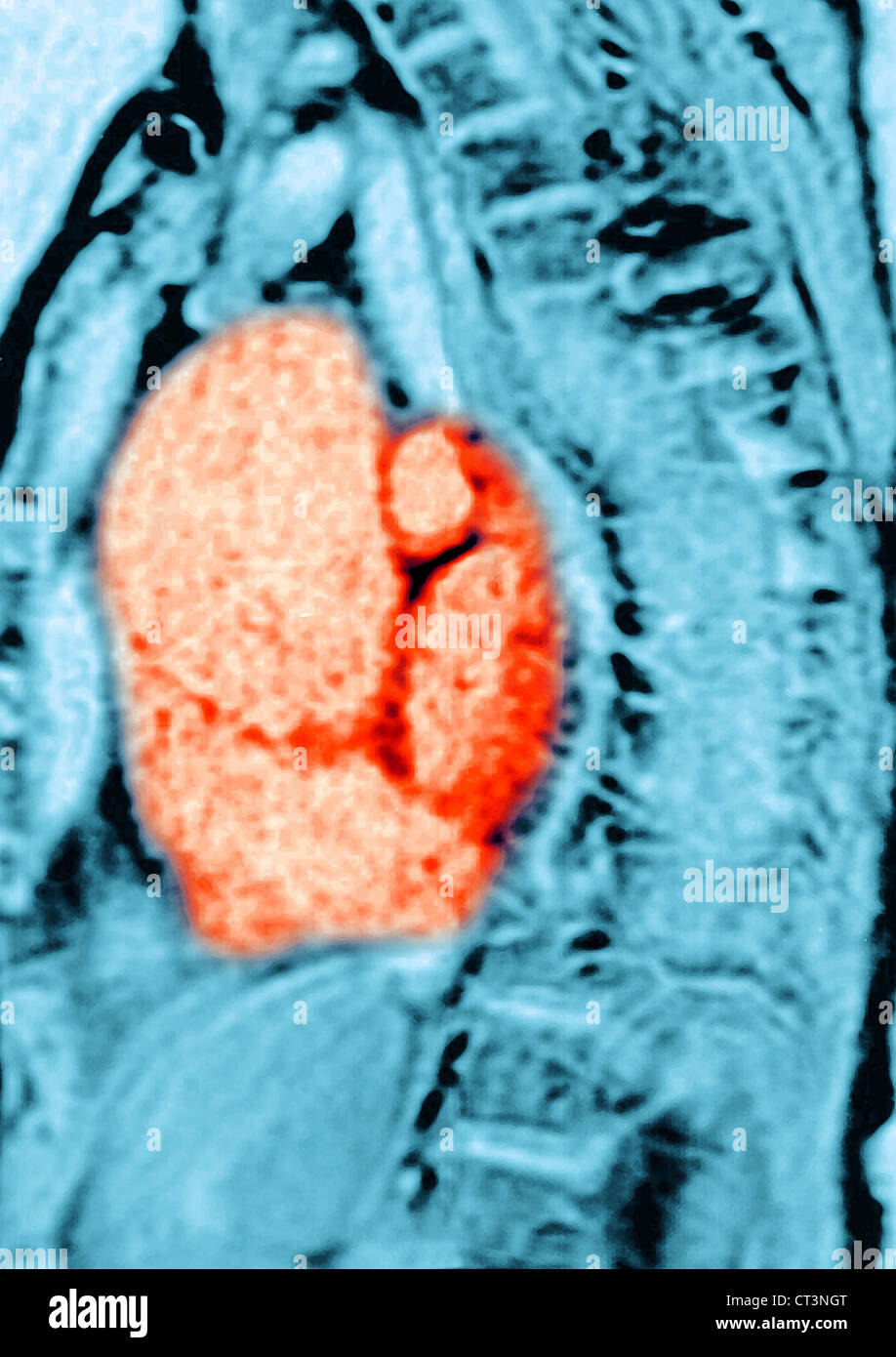 Cardiac Mri High Resolution Stock Photography and Images - Alamy