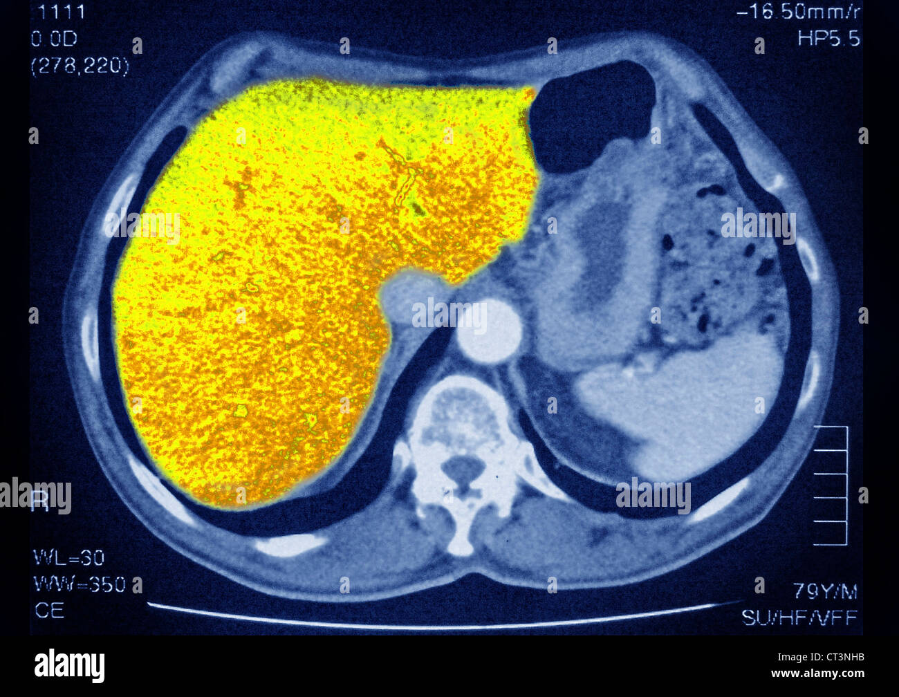 Normal Liver High Resolution Stock Photography and Images - Alamy