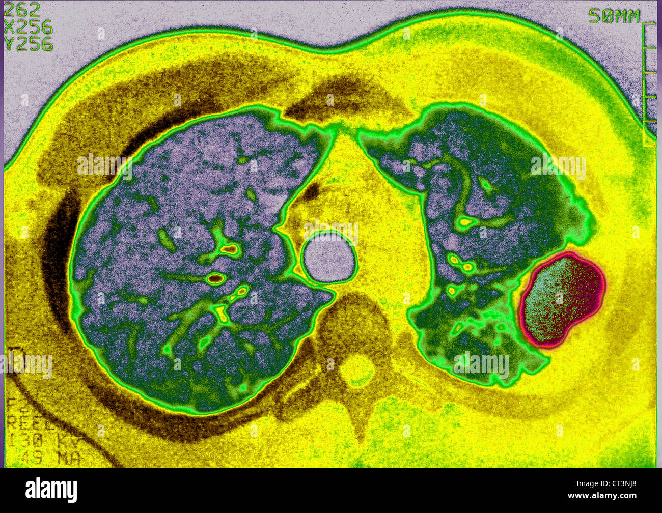 LUNG SCAN FOR EMPHYSEMA Stock Photo - Alamy