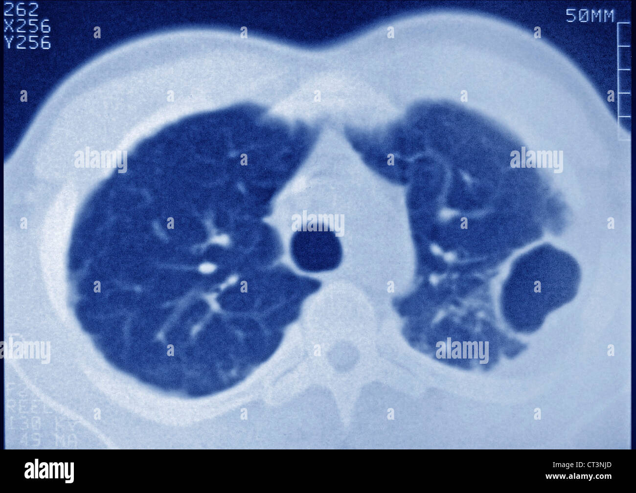 LUNG SCAN FOR EMPHYSEMA Stock Photo - Alamy