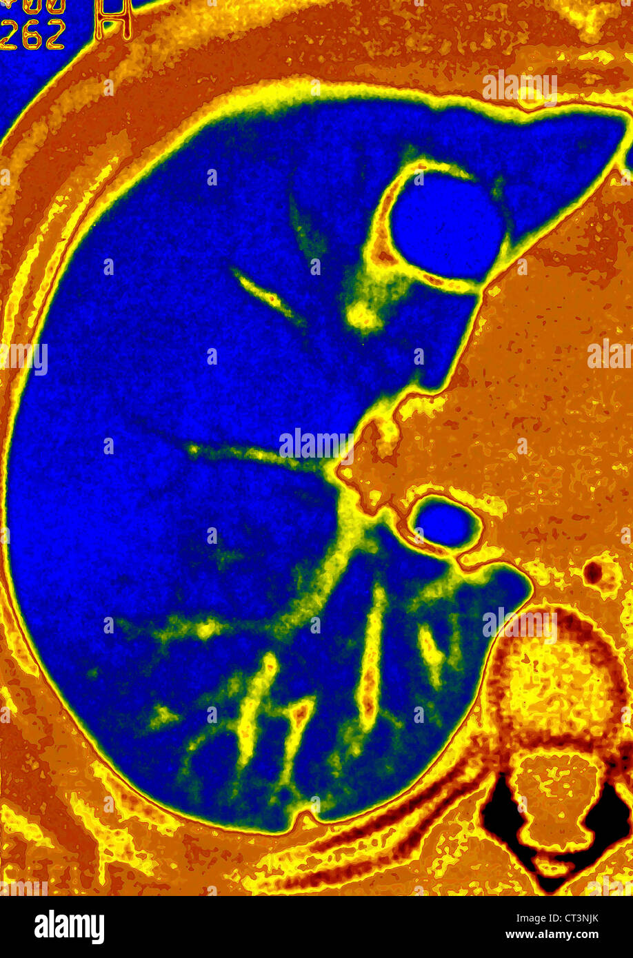 LUNG SCAN FOR EMPHYSEMA Stock Photo - Alamy
