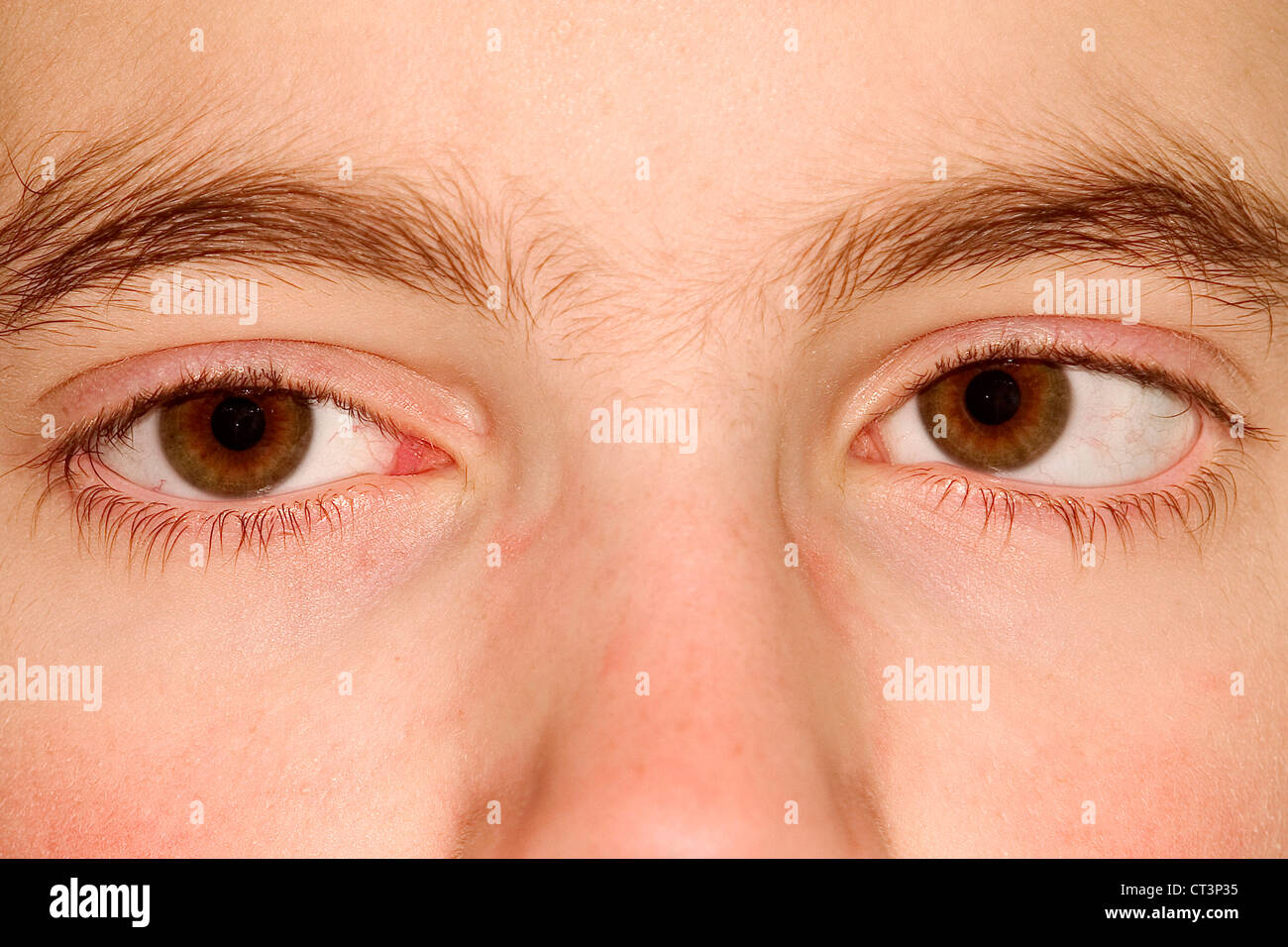 Eye Eyes Strabismus High Resolution Stock Photography and Images - Alamy