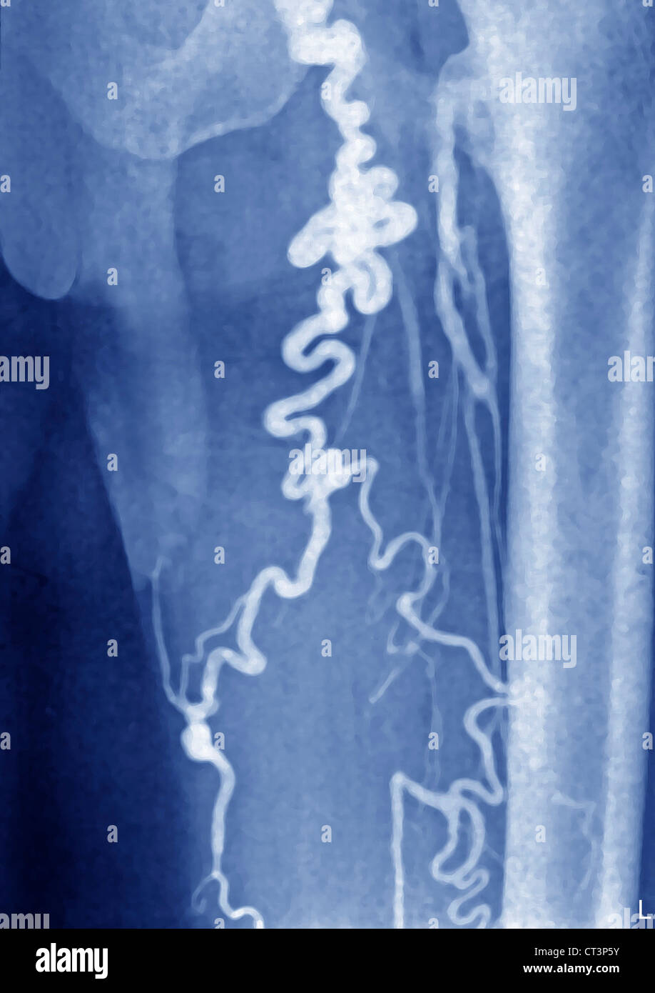 VARICOSE VEIN, ANGIOGRAPHY Stock Photo - Alamy