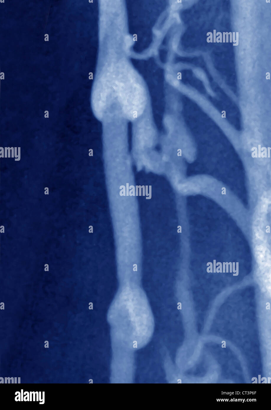 Venous hi-res stock photography and images - Alamy