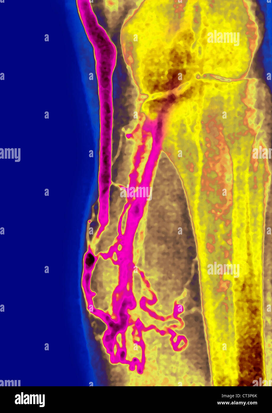 Saphenous vein hi-res stock photography and images - Alamy
