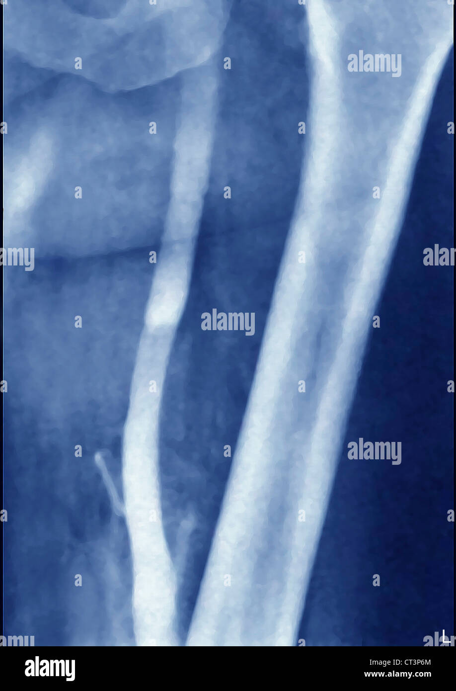 FEMORAL VEIN, ANGIOGRAPHY Stock Photo - Alamy