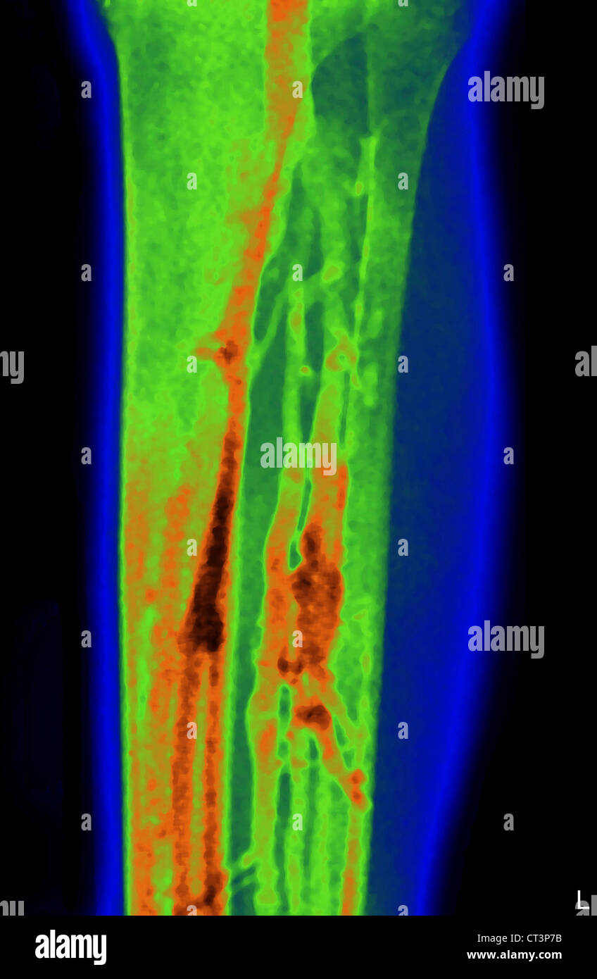 LOWER LIMB, ANGIOGRAPHY Stock Photo - Alamy