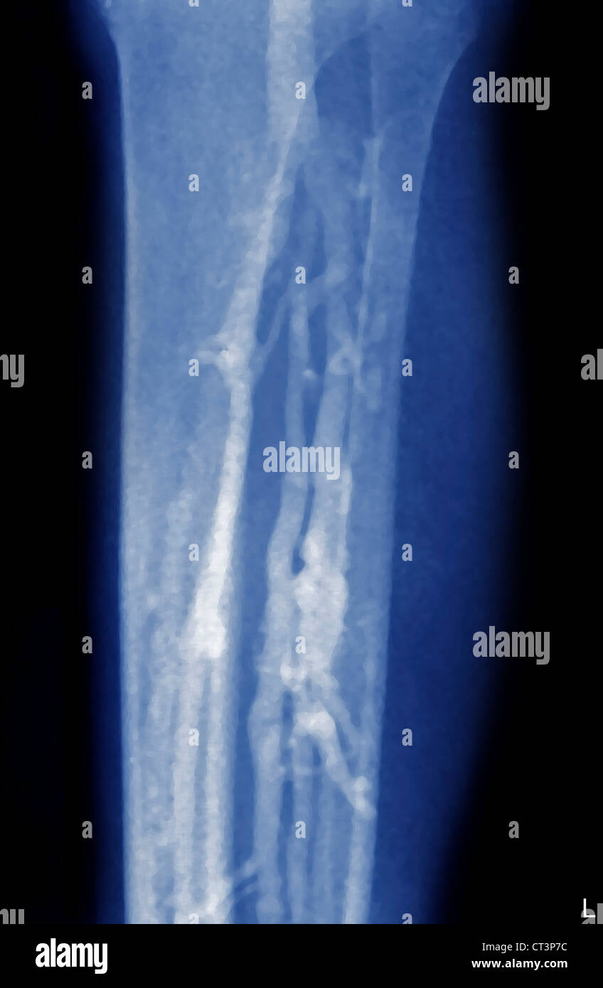 LOWER LIMB, ANGIOGRAPHY Stock Photo - Alamy