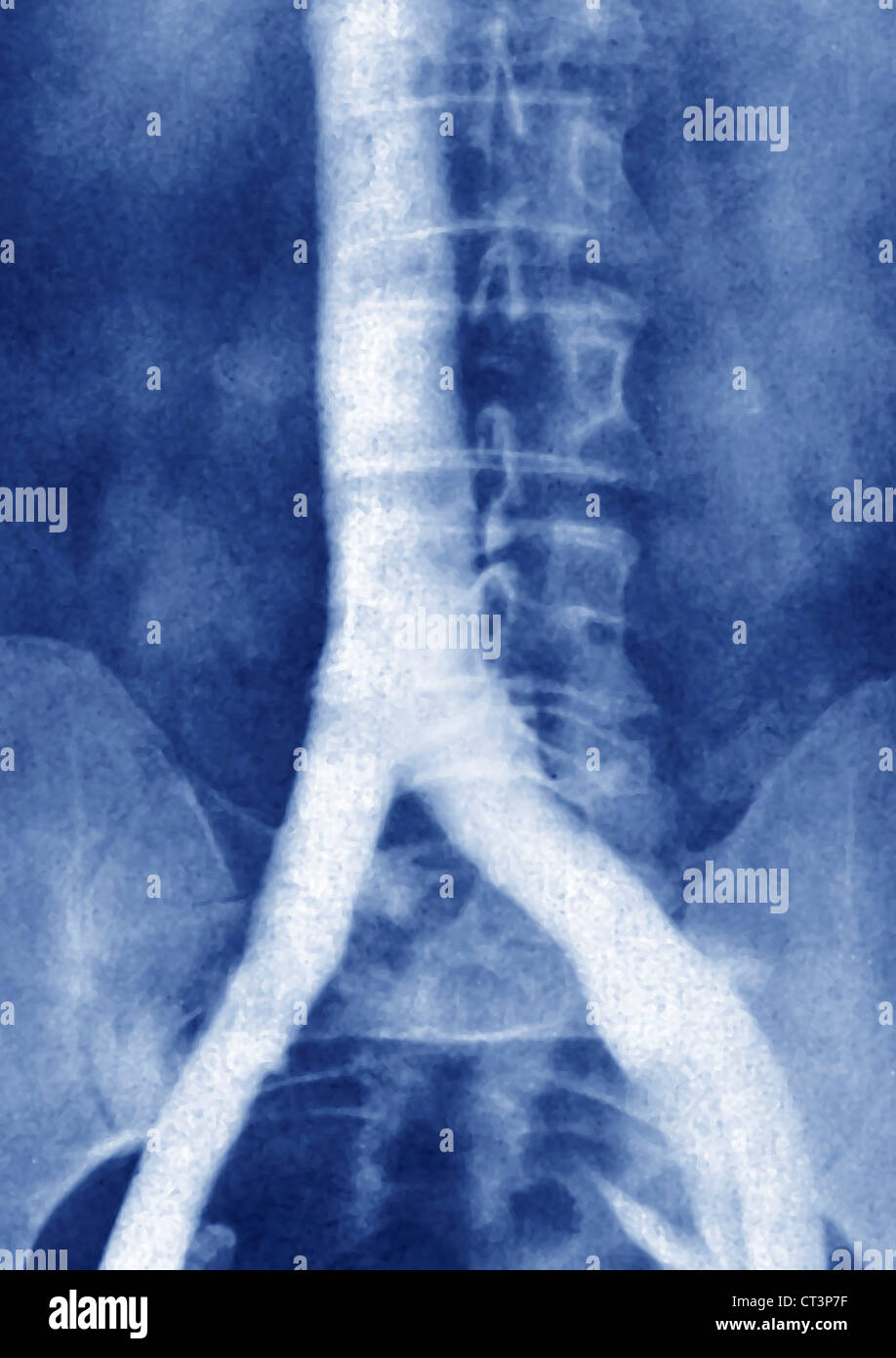 VENA CAVA, ANGIOGRAPHY Stock Photo - Alamy