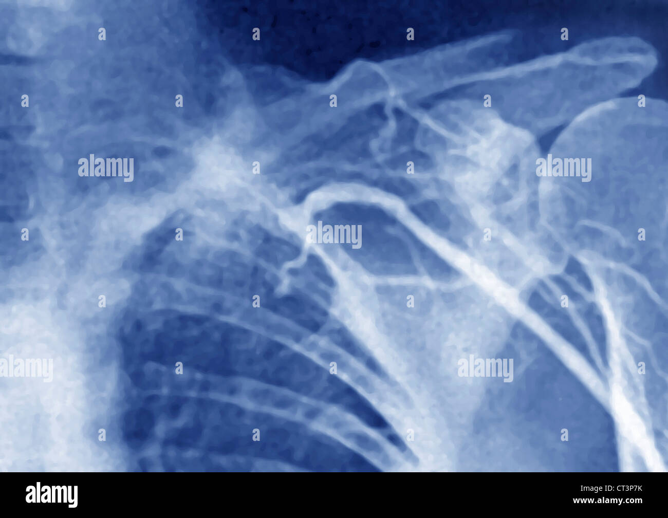 THOMBOSED VEIN, ANGIOGRAPHY Stock Photo - Alamy