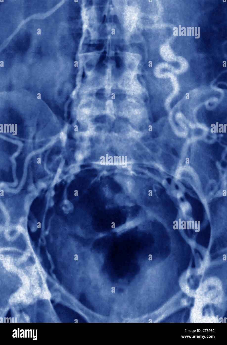 Blood vessels of pelvis hi-res stock photography and images - Alamy