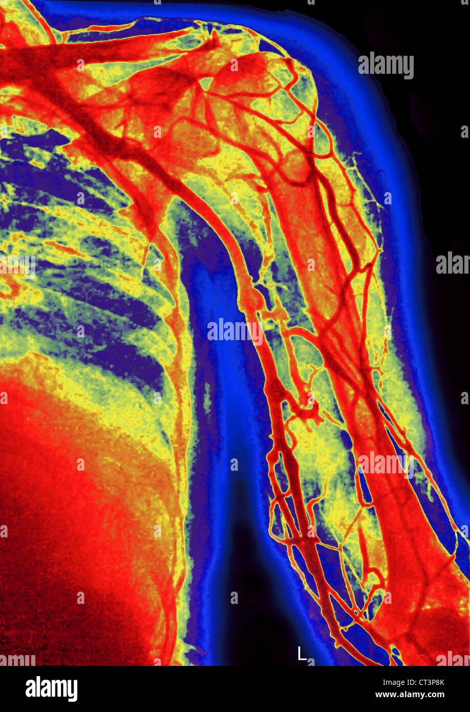 UPPER LIMB, ANGIOGRAPHY Stock Photo - Alamy