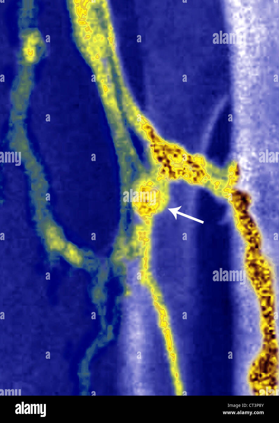 THOMBOSED VEIN, ANGIOGRAPHY Stock Photo - Alamy