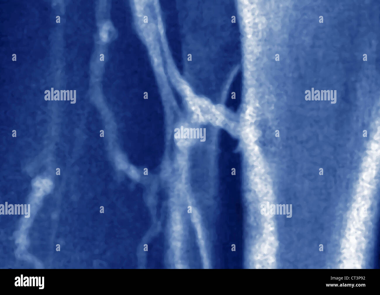 Lower limb angiography hi-res stock photography and images - Alamy