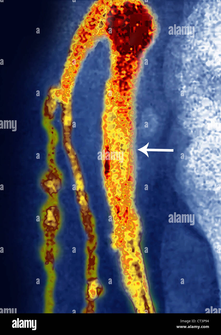 THOMBOSED VEIN, ANGIOGRAPHY Stock Photo - Alamy