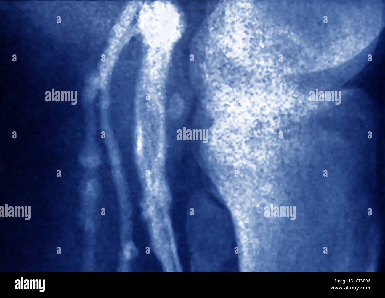 THOMBOSED VEIN, ANGIOGRAPHY Stock Photo - Alamy
