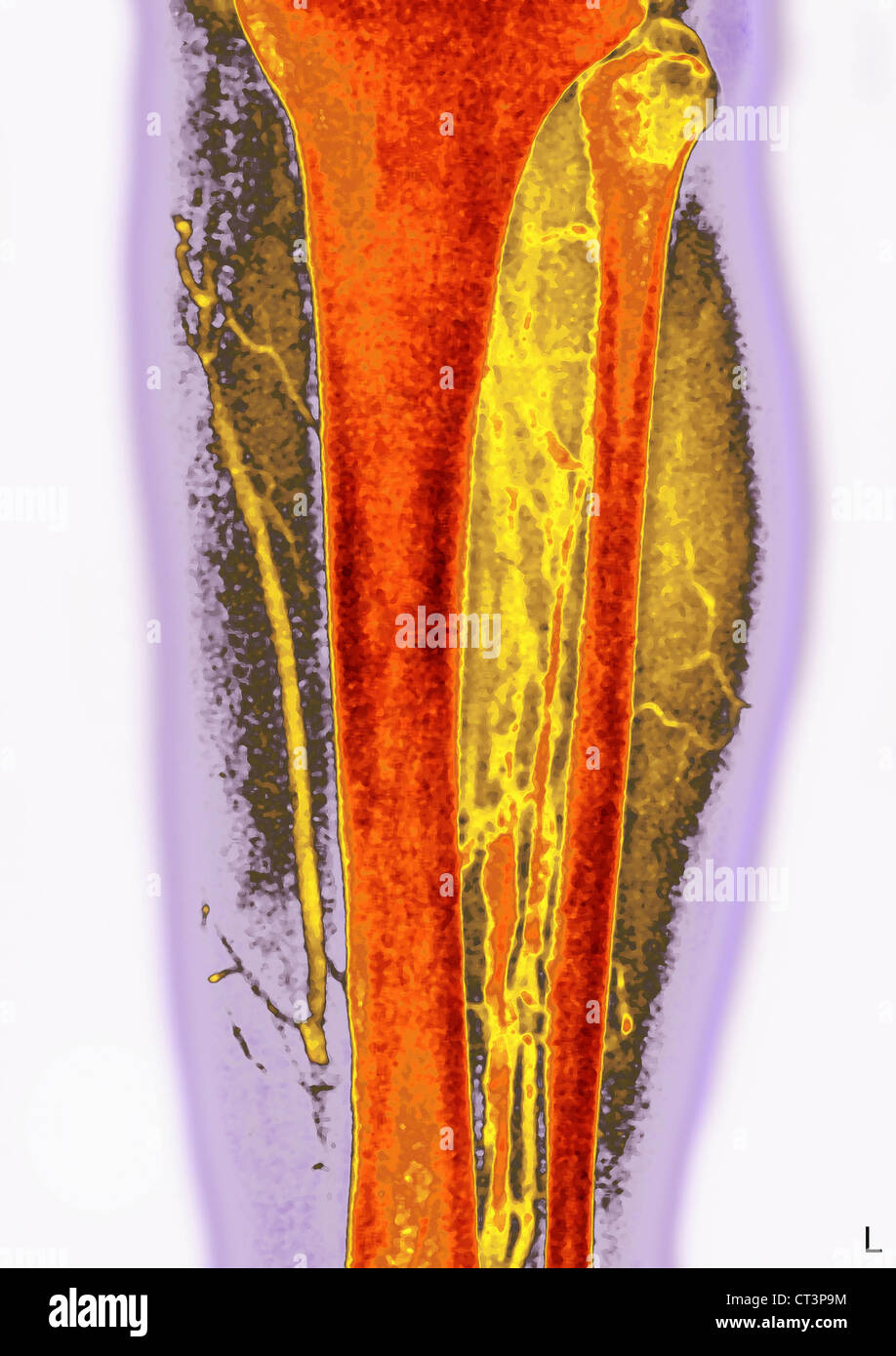 DEEP VEIN THROMBOSIS Stock Photo - Alamy