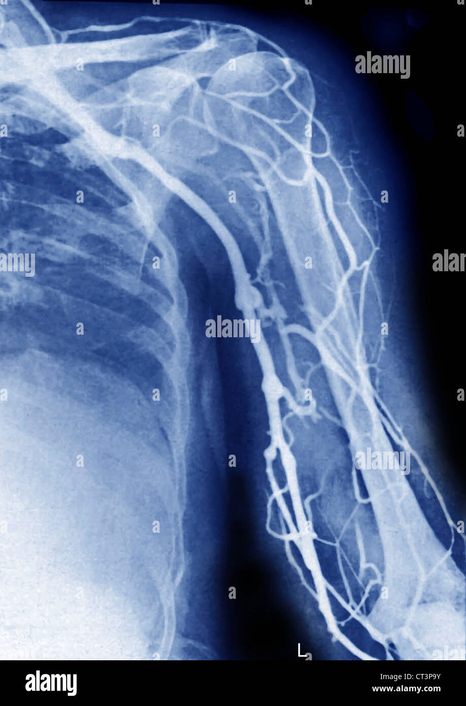 UPPER LIMB, ANGIOGRAPHY Stock Photo - Alamy