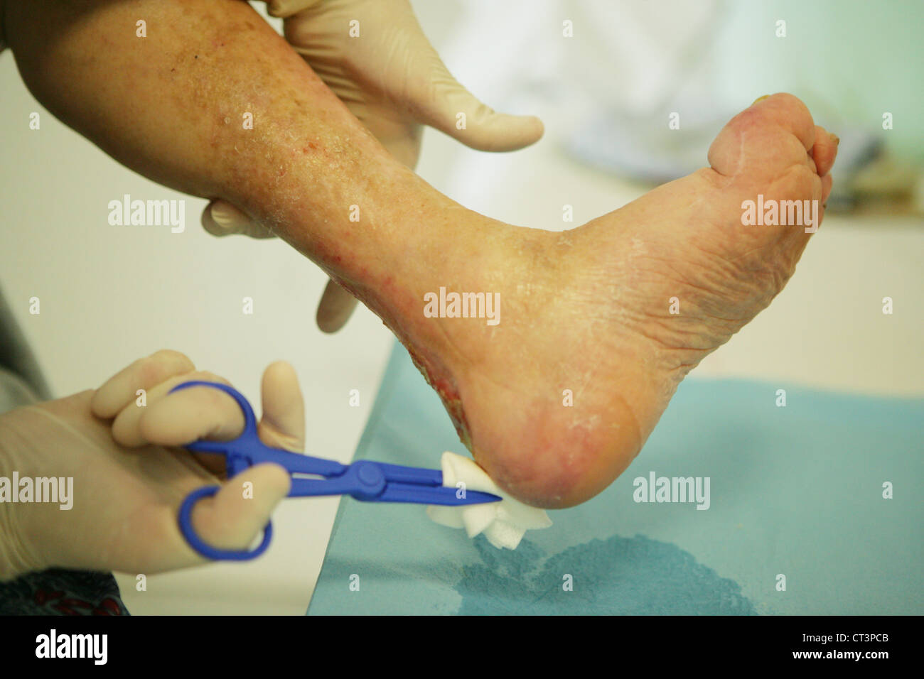 Necrosis foot hi-res stock photography and images - Alamy