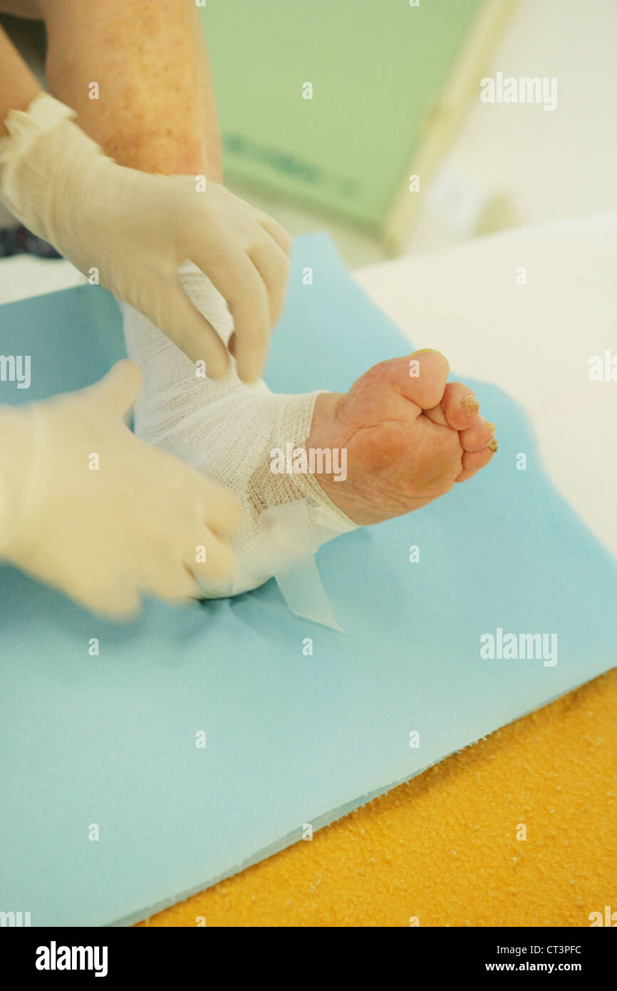 Decubitus ulcer foot hi-res stock photography and images - Alamy