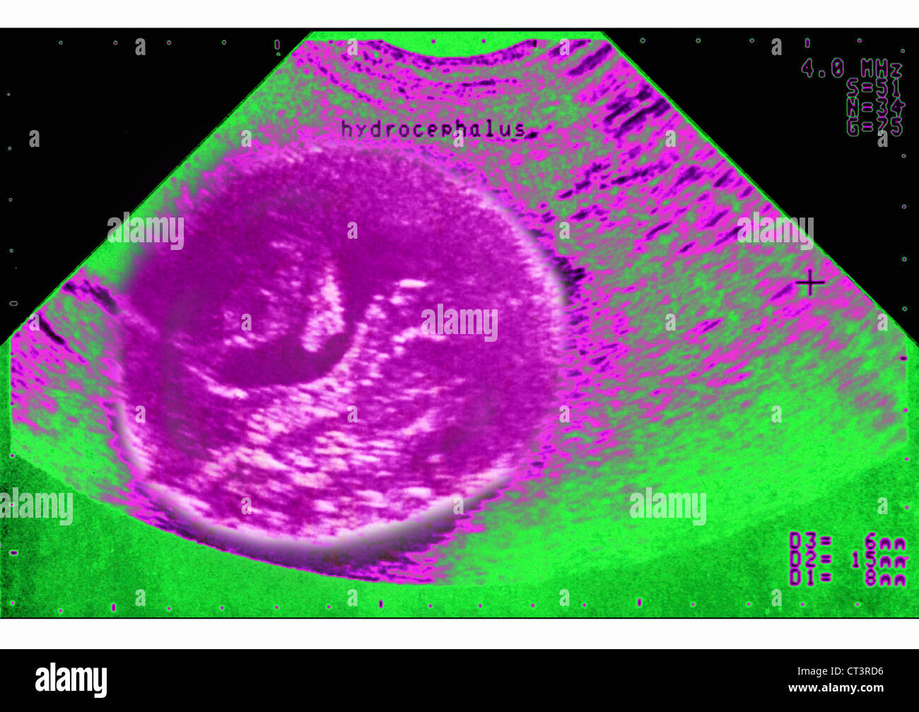 Hydrocephalus hi-res stock photography and images - Alamy