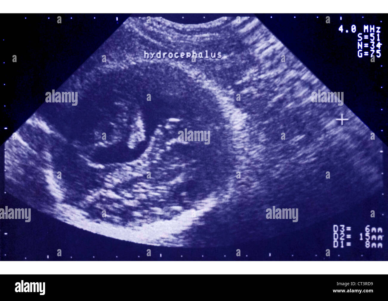 Hydrocephalus hi-res stock photography and images - Alamy