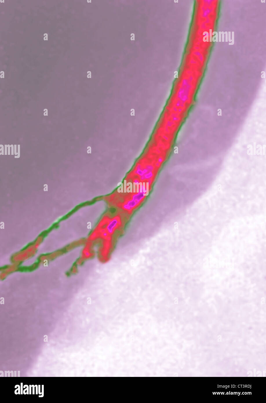 ARTERIAL EMBOLIZATION, ANGIOGR Stock Photo - Alamy