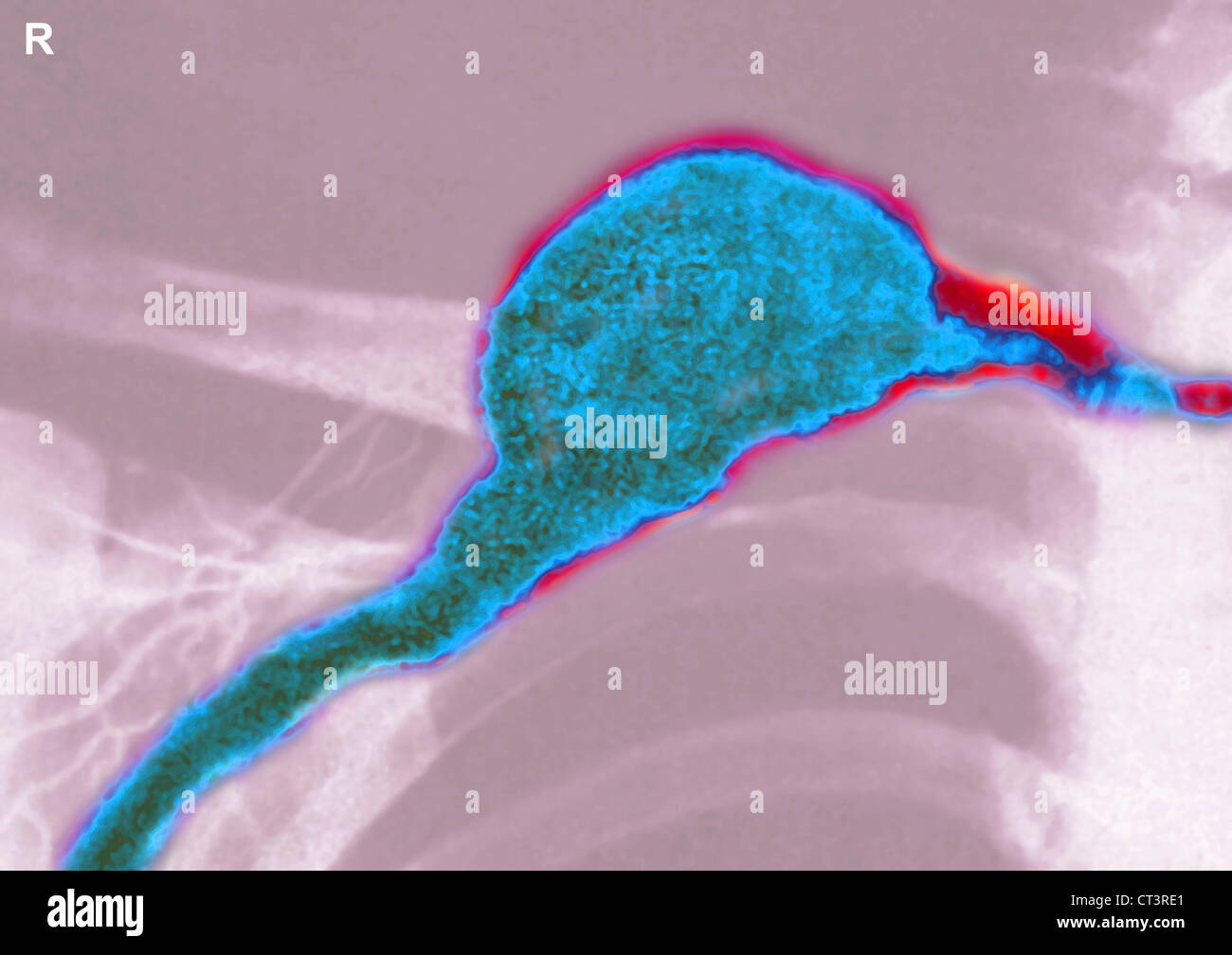 ANEURYSM OF AN ARTERY Stock Photo - Alamy