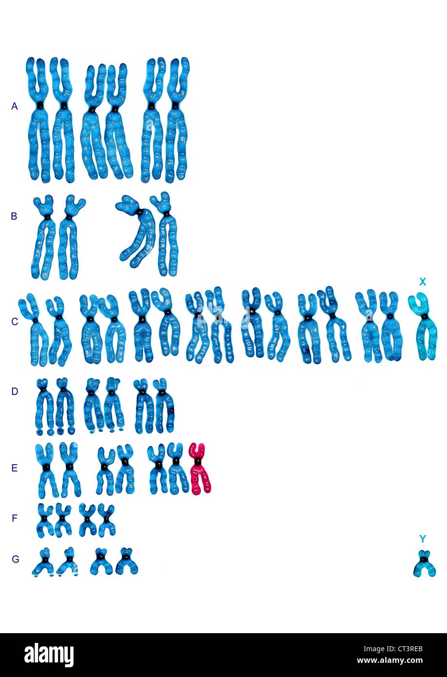 Trisomy 18 hi-res stock photography and images - Alamy