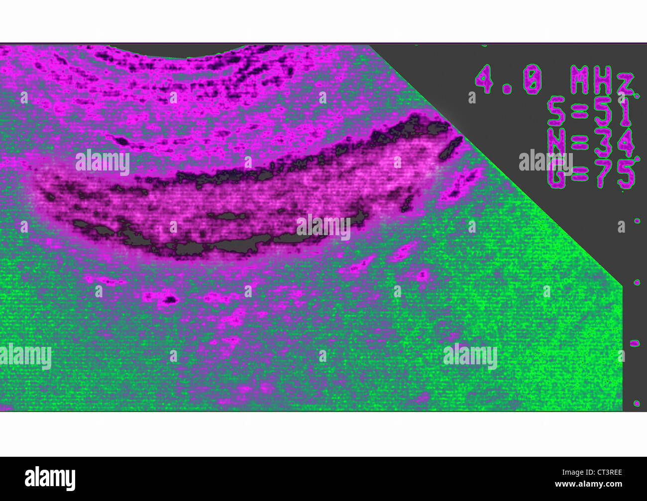 Spina bifida hi-res stock photography and images - Alamy