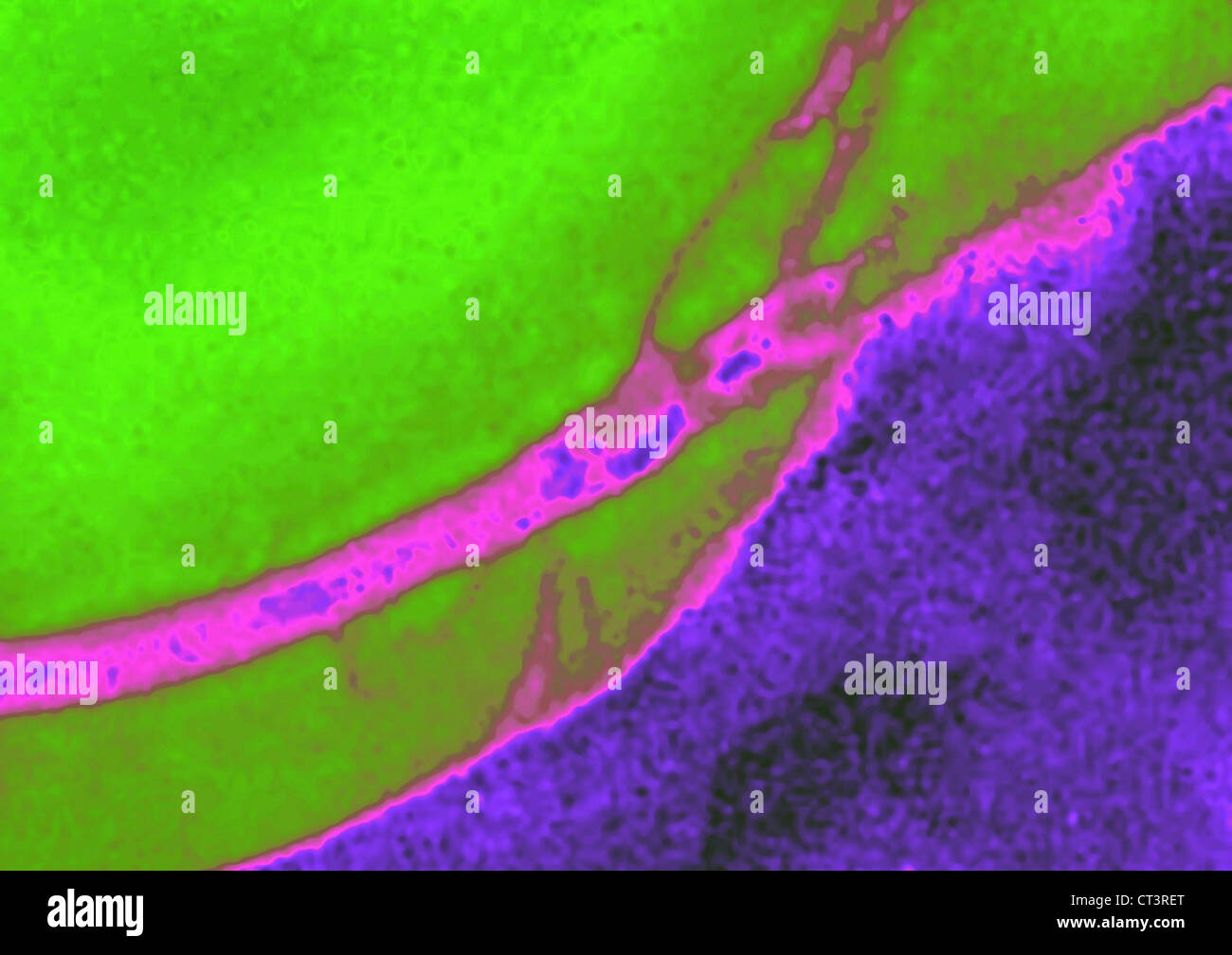 ARTERIAL EMBOLIZATION, ANGIOGR Stock Photo - Alamy