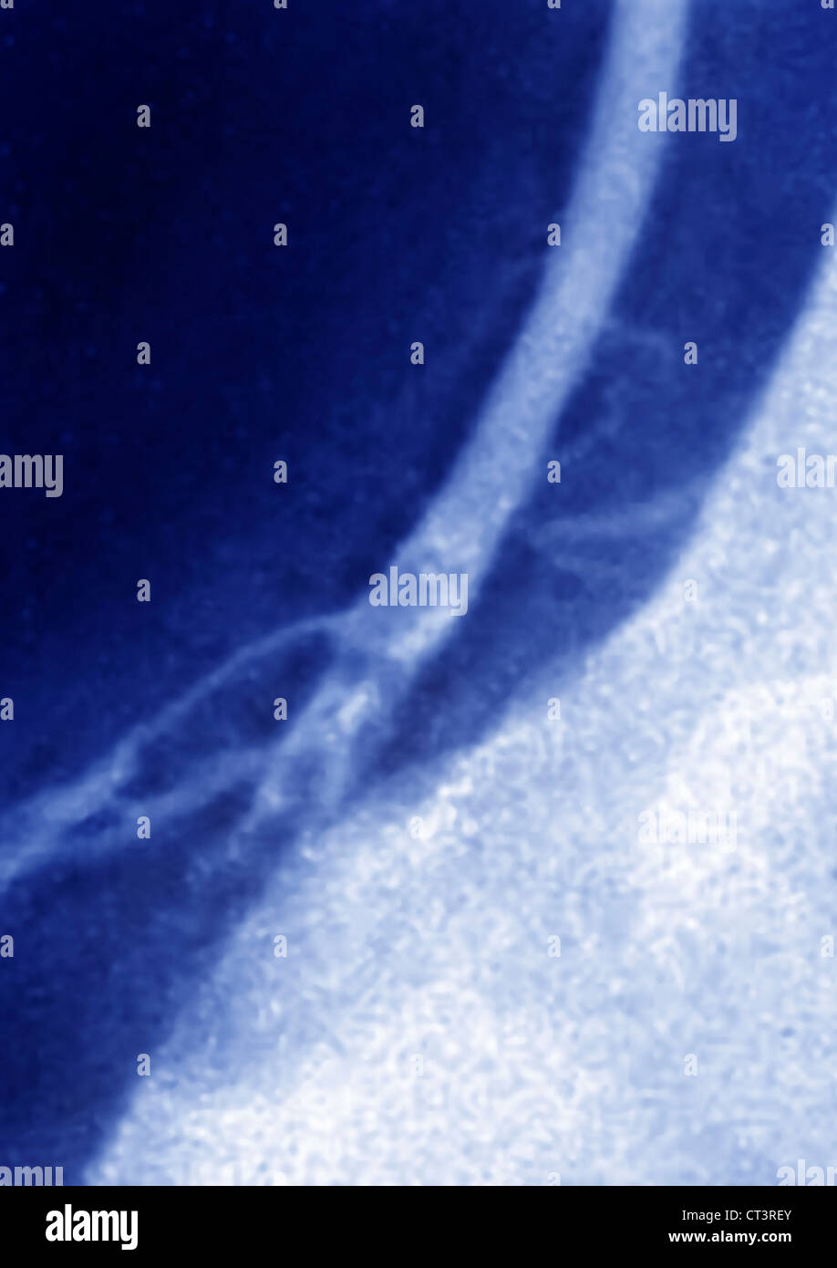 ARTERIAL EMBOLIZATION, ANGIOGR Stock Photo - Alamy