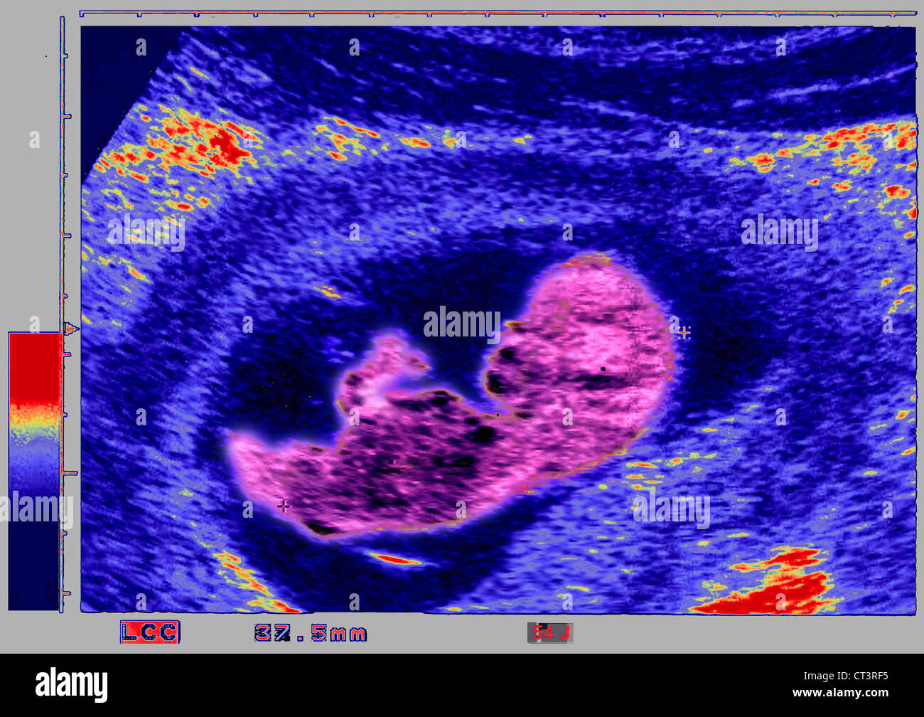 ULTRASOUND BIOMETRY OF THE FETUS Stock Photo - Alamy