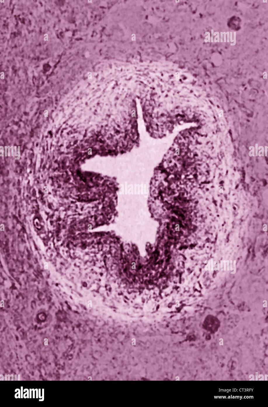 Arteriosclerosis High Resolution Stock Photography and Images - Alamy