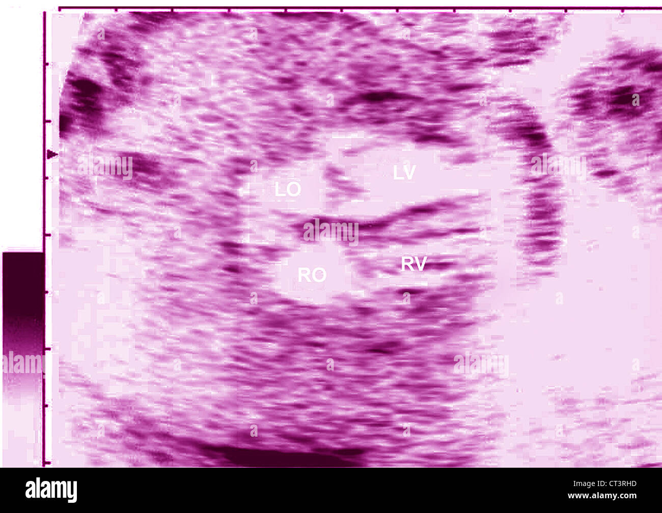 ULTRASOUND BIOMETRY OF THE FETUS Stock Photo - Alamy