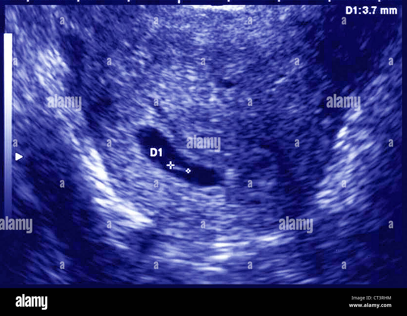 EMBRYO, ULTRASOUND BIOMETRY Stock Photo - Alamy