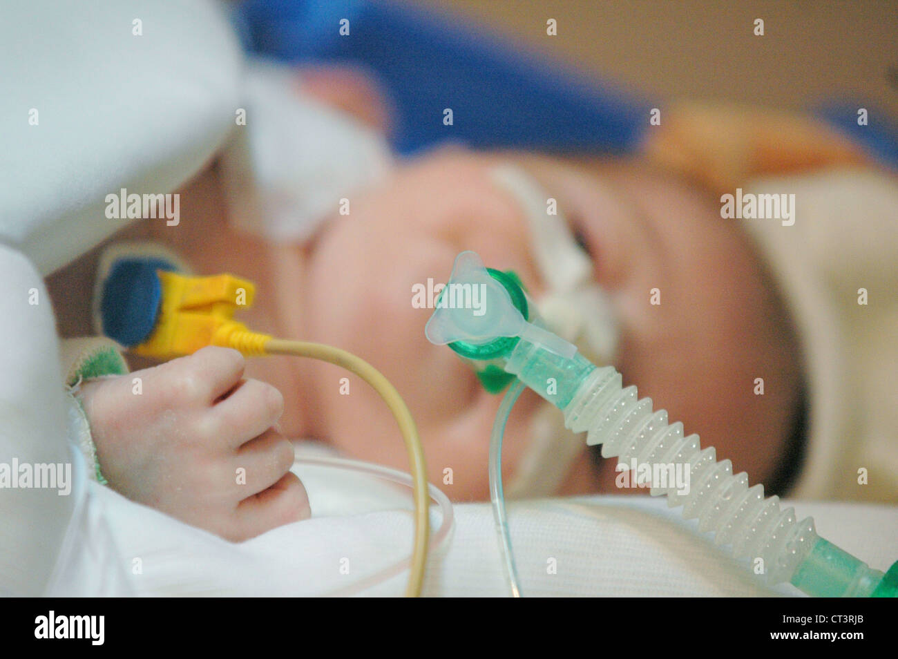 Intubated newborn hi-res stock photography and images - Alamy