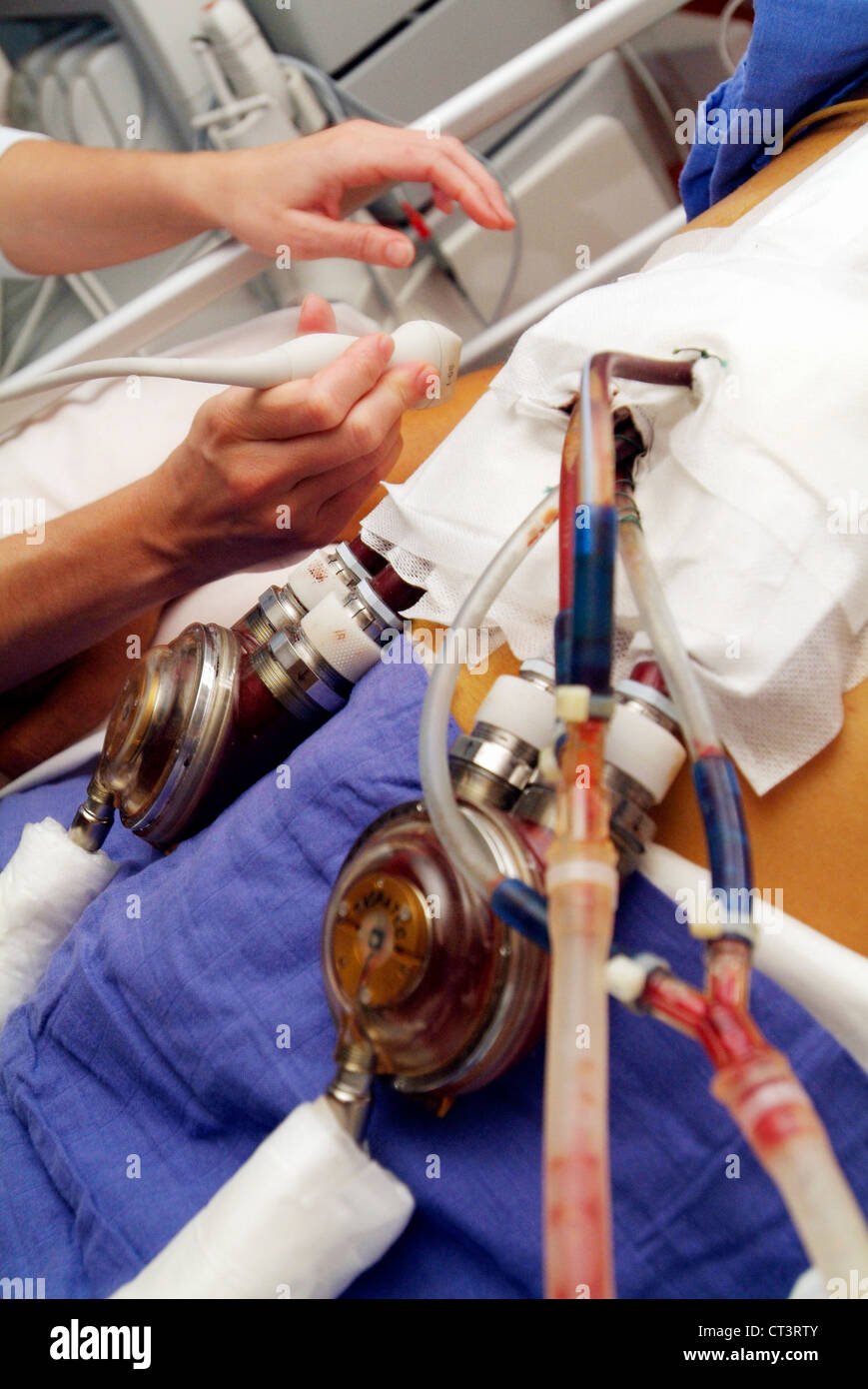 Ventricular assist device hi-res stock photography and images - Alamy
