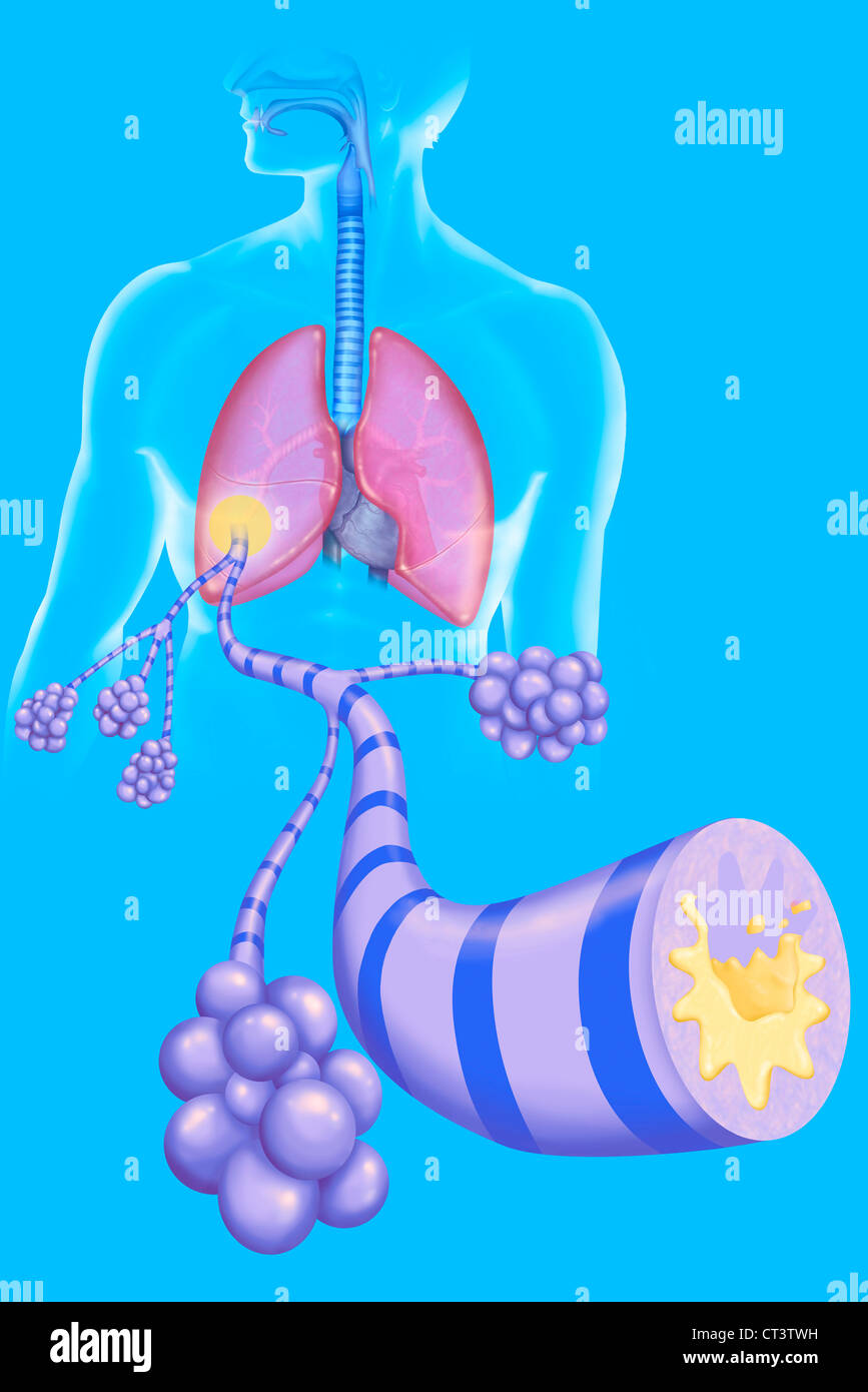 Lungs bronchial tree airways hi-res stock photography and images - Alamy