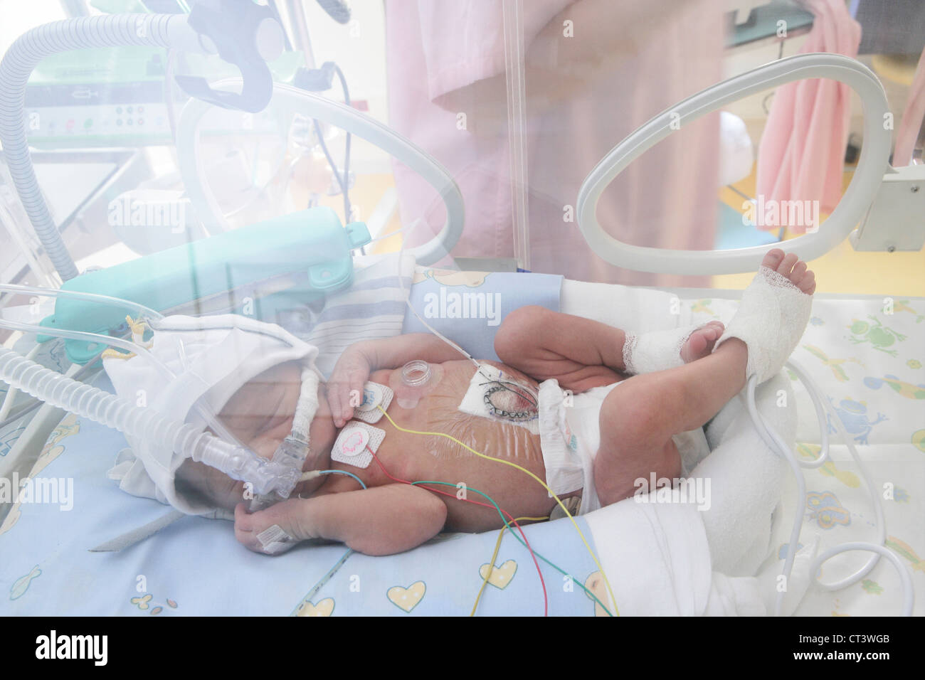 Pre term baby hi-res stock photography and images - Alamy