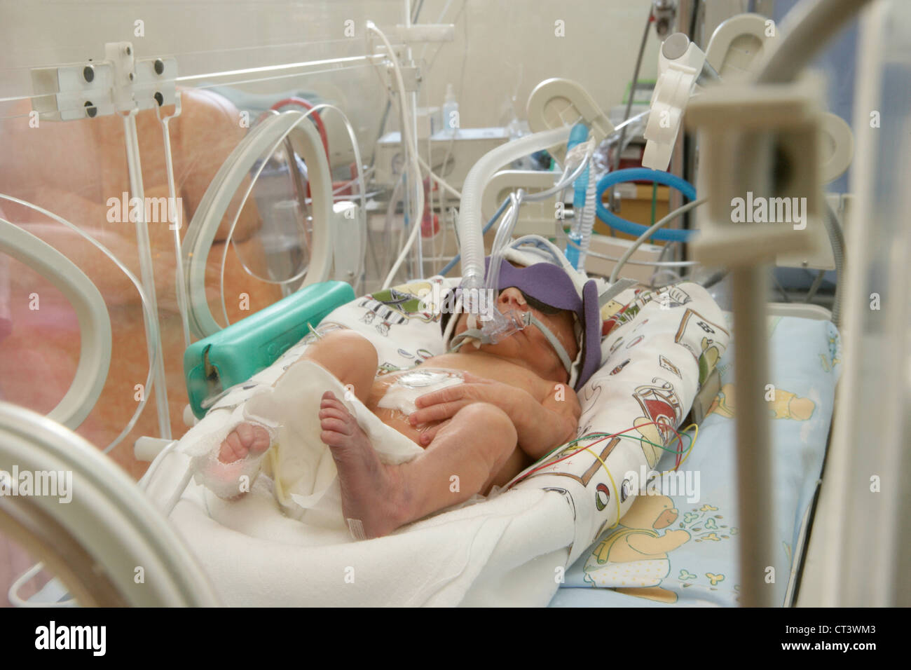 NEONATAL JAUNDICE, PHOTOTHERAPY Stock Photo - Alamy