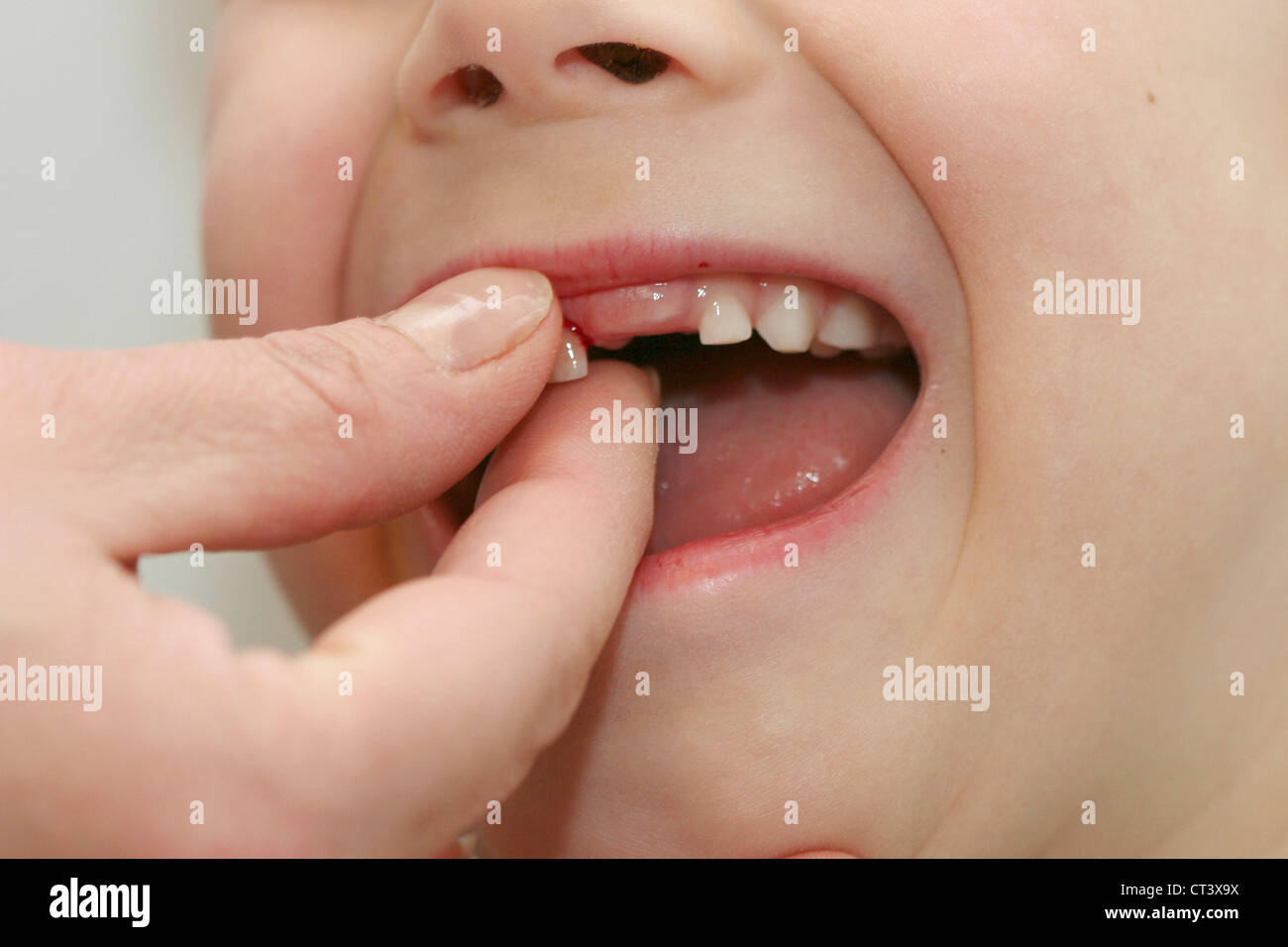 LOSING MILK TEETH Stock Photo - Alamy