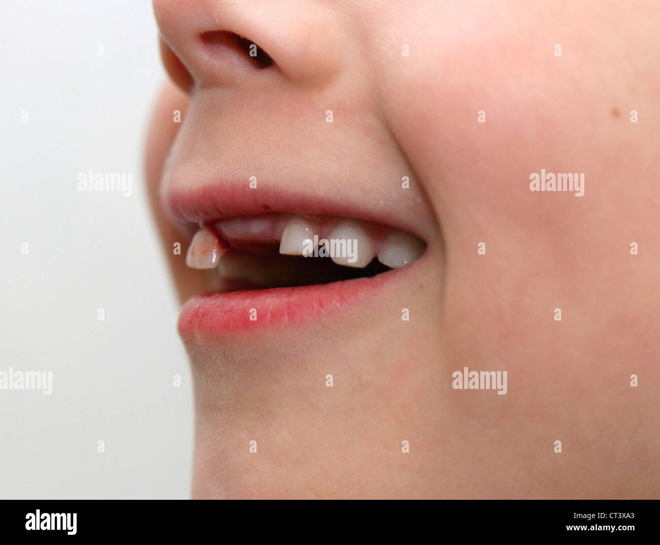 Temporary teeth hi-res stock photography and images - Alamy