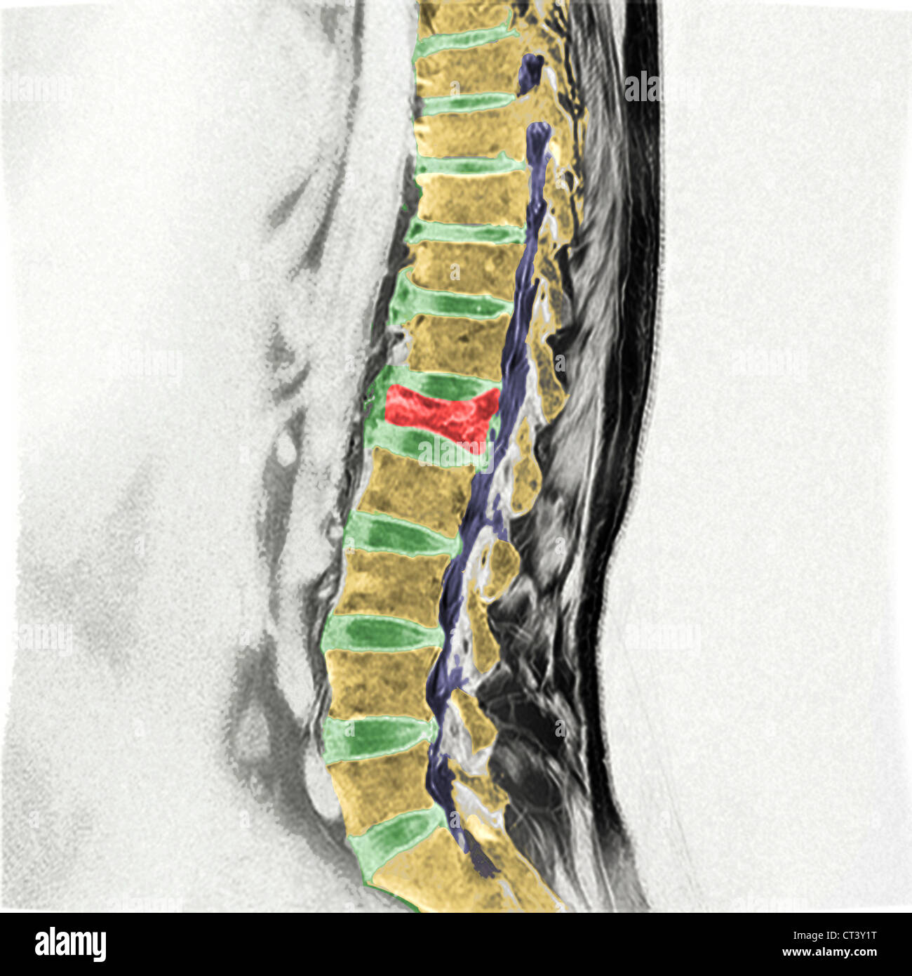 COMPRESSION FRACTURE, MRI Stock Photo - Alamy