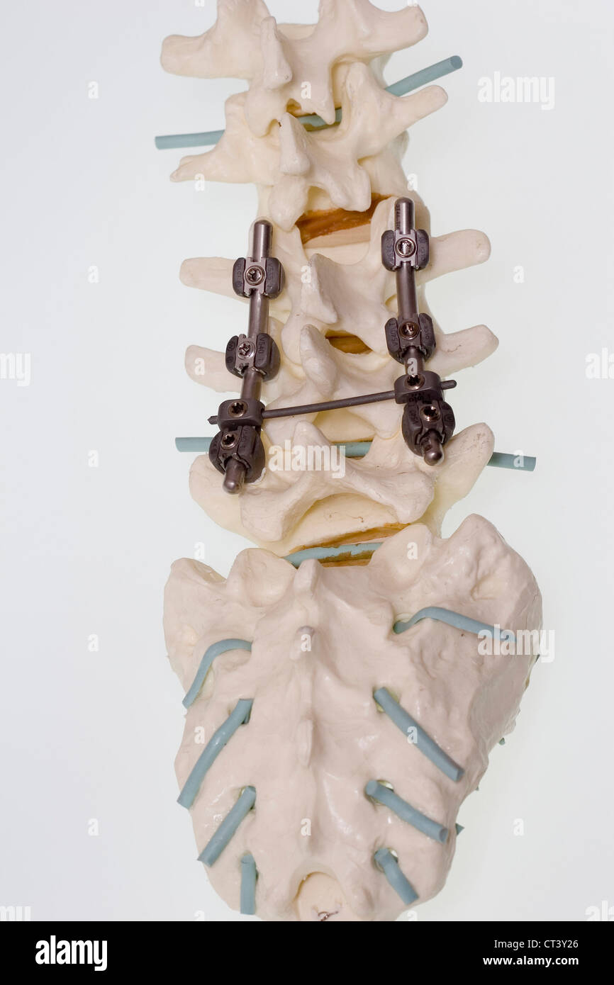 Fixator hi-res stock photography and images - Alamy