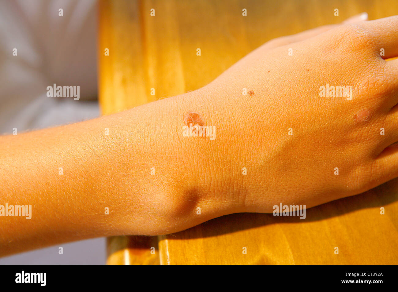 Wart hand female hi-res stock photography and images - Alamy
