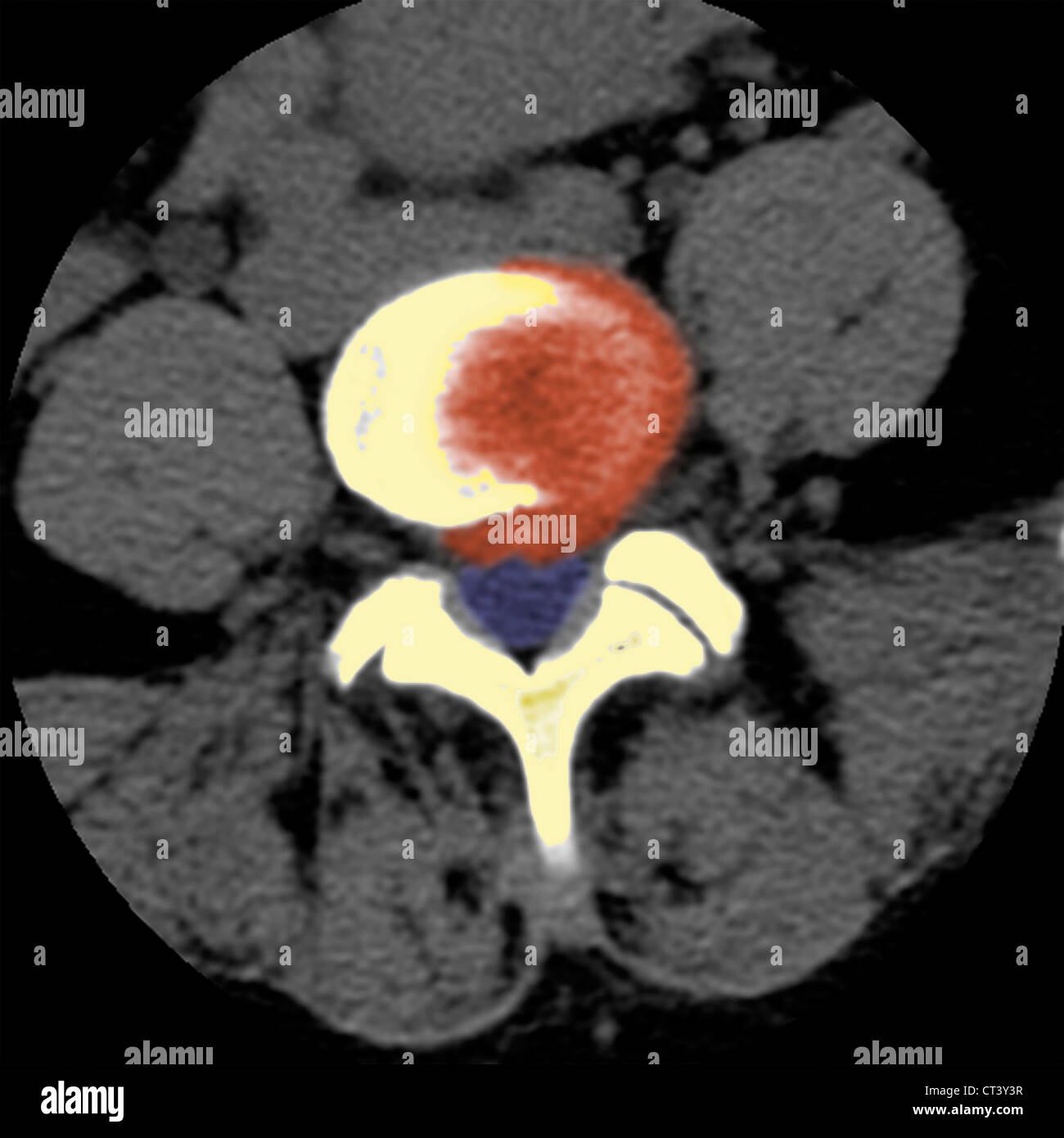 HERNIATED DISK, SCAN Stock Photo - Alamy